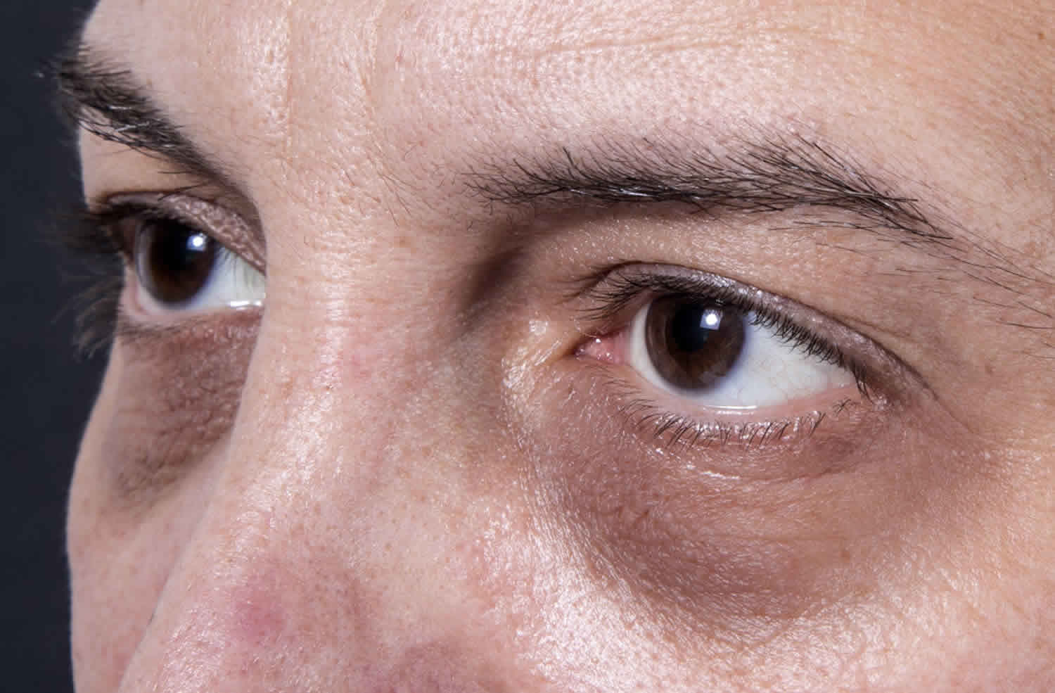 Dark Circles And Tired Eyes My Skyn Dark Circles And Tired Eyes My Skyn