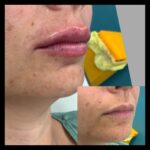 Lip Filler Swelling Stages: A Complete Guide - MySkyn Clinic