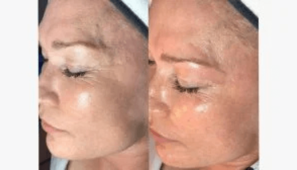 HydraFacial Before and After | Transform Skin Instantly