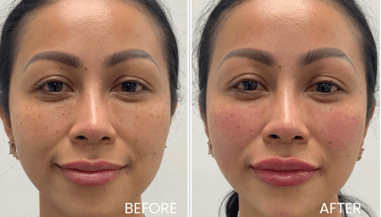 Lip Filler Before and After: MySkyn Clinic