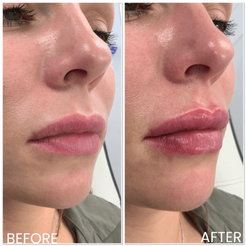 Lip Filler Before and After: MySkyn Clinic