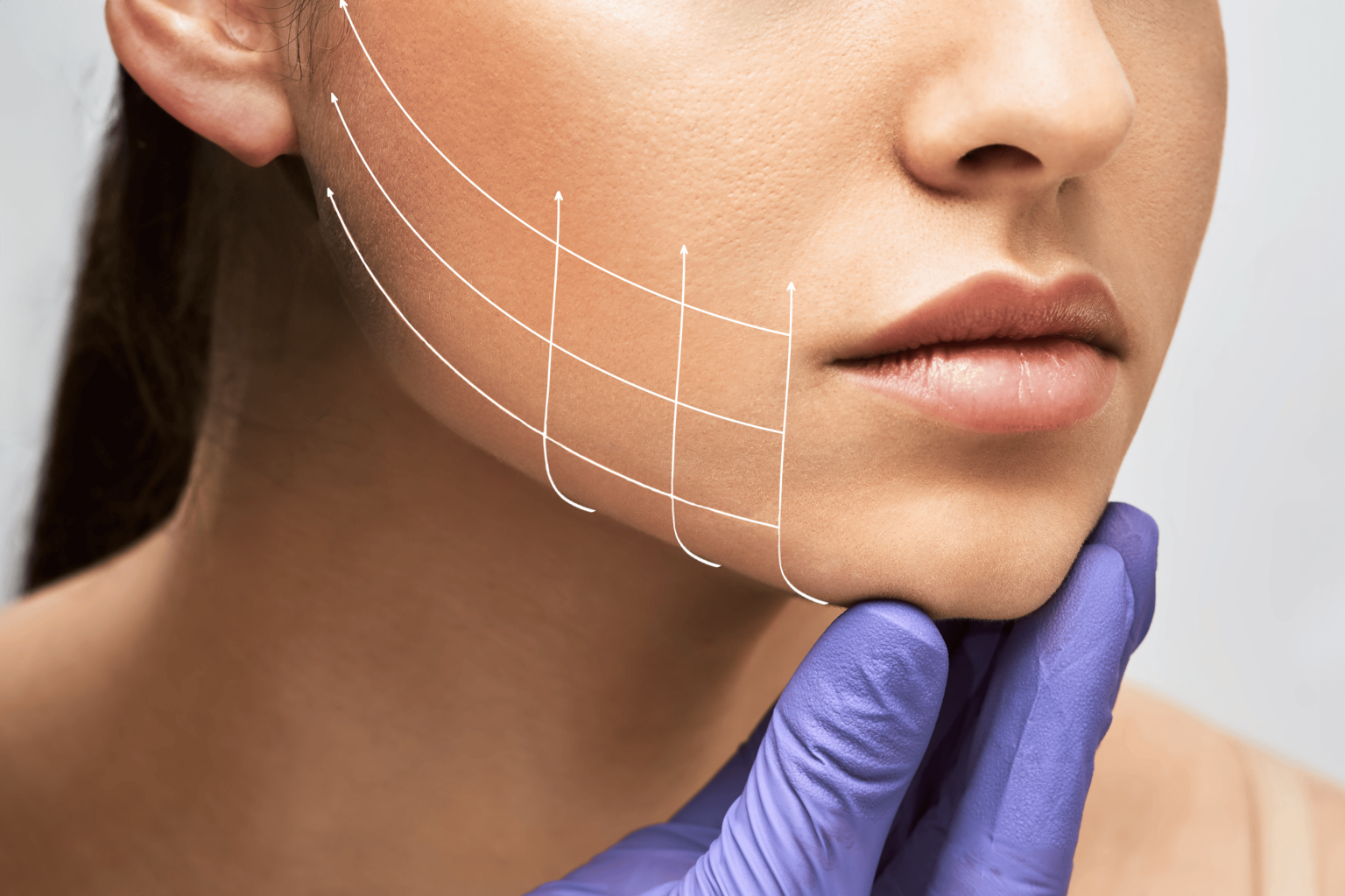 Thread Lift Bradford | Thread Lift Before and After