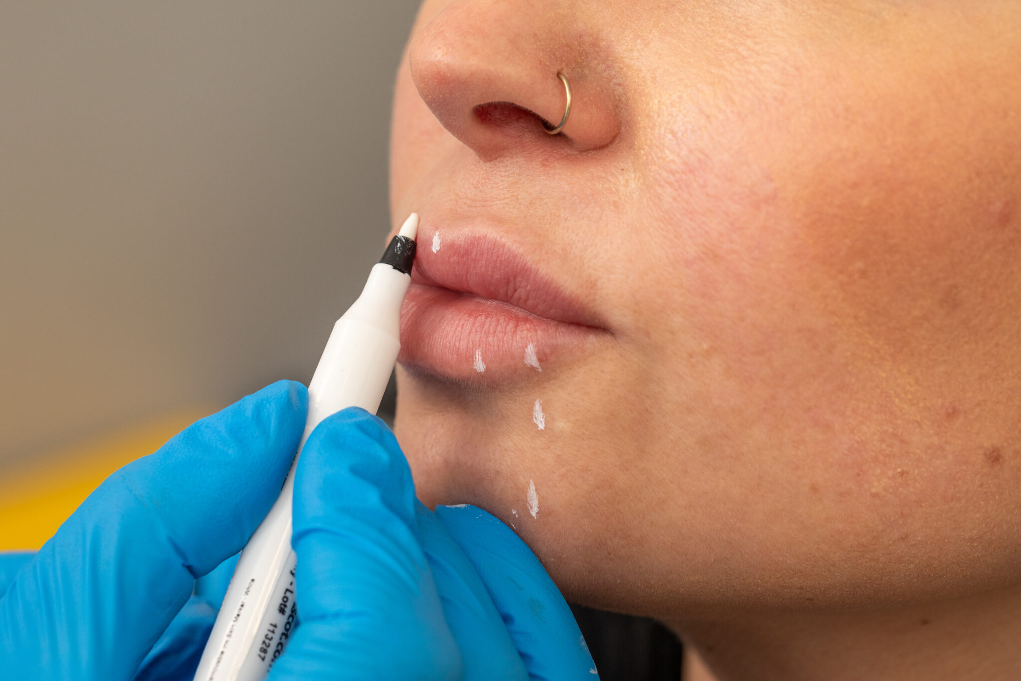 Lip Fillers Bradford | Lip Filler Near Me - MySkyn Clinic